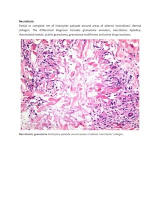 dermatopathology granulomatous inflammation.pdf