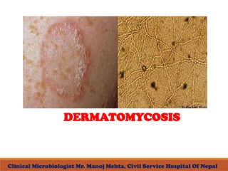 Dermatophyte Candidiasis,.pptx Manoj Mahato | PPTX