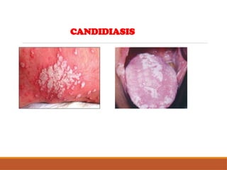 Dermatophyte Candidiasis,.pptx Manoj Mahato | PPTX