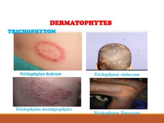 Dermatophyte Candidiasis,.pptx Manoj Mahato | PPTX