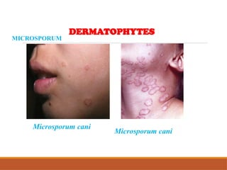 Dermatophyte Candidiasis,.pptx Manoj Mahato | PPTX