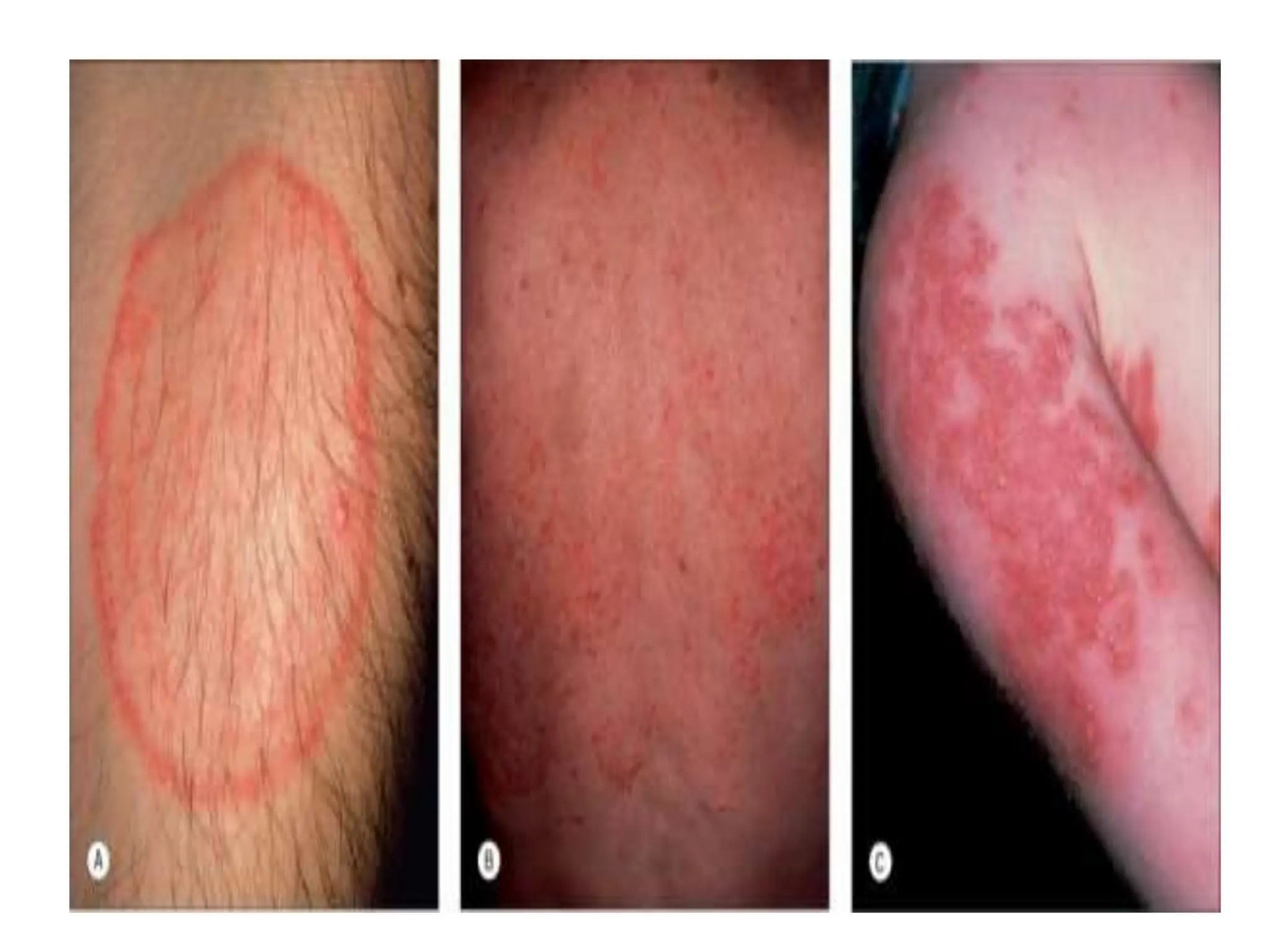 Dermatophyte infection (2).pptx | Skin and Dermatology | Diseases and ...