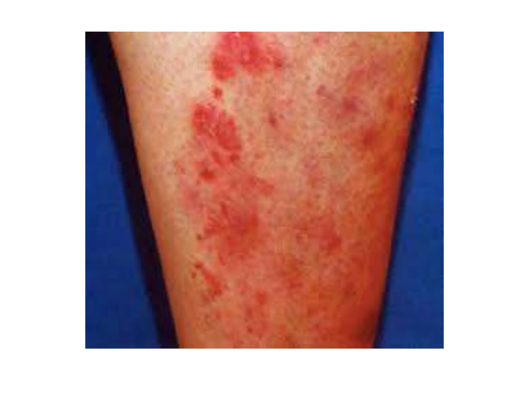 Dermatophyte infection (2).pptx | Skin and Dermatology | Diseases and ...