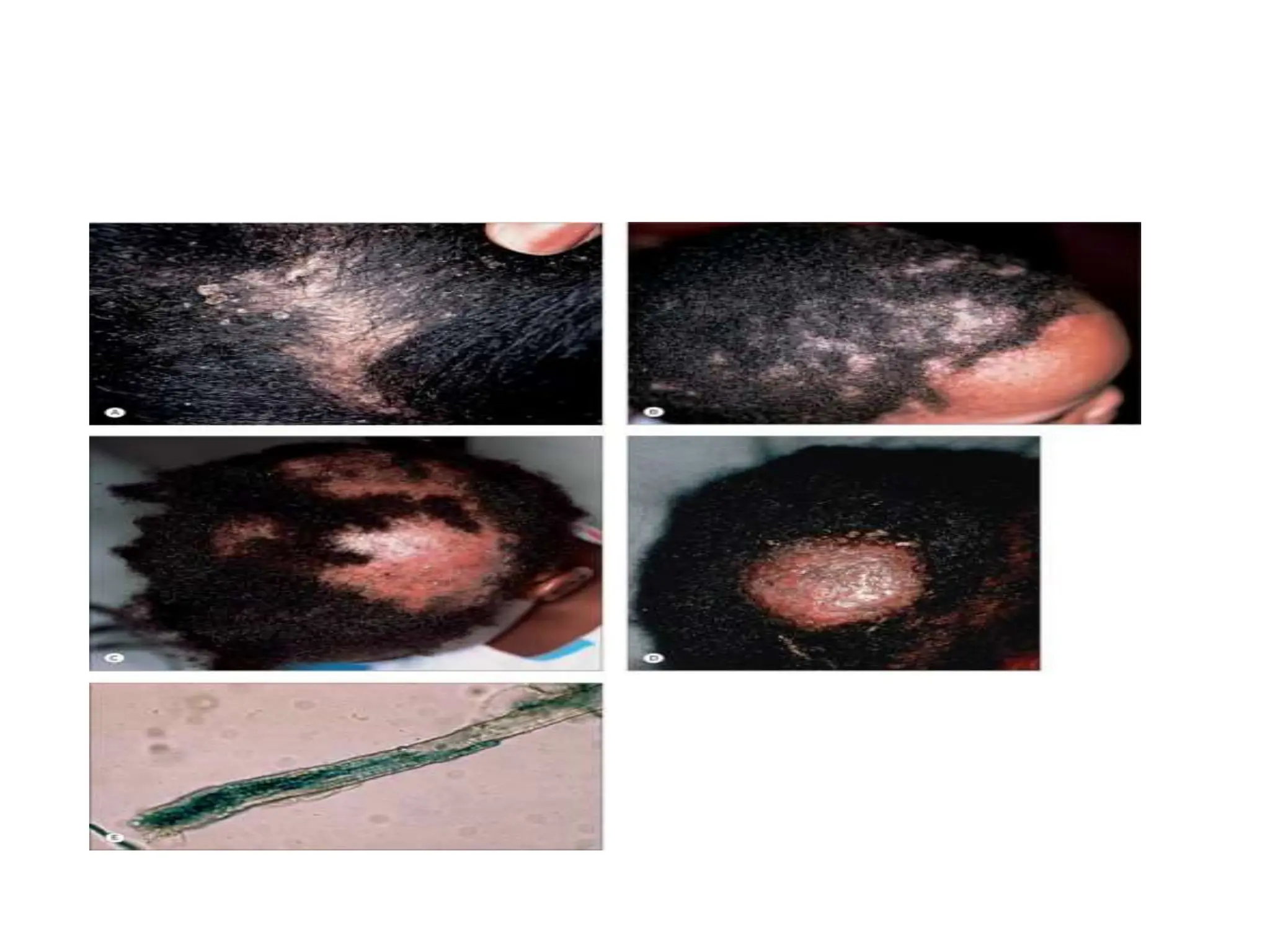 Dermatophyte infection (2).pptx | Skin and Dermatology | Diseases and ...