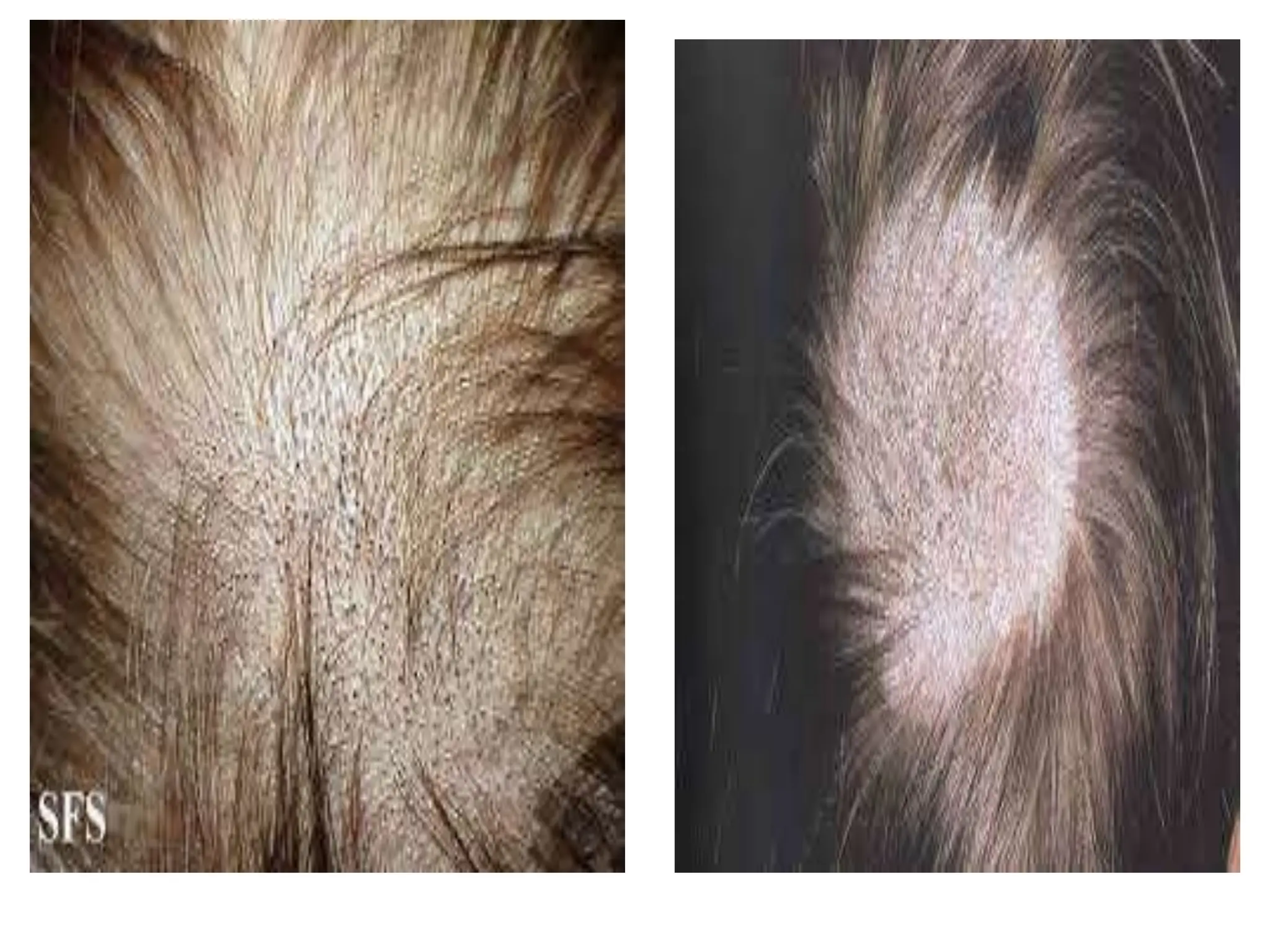 Dermatophyte infection (2).pptx | Skin and Dermatology | Diseases and ...