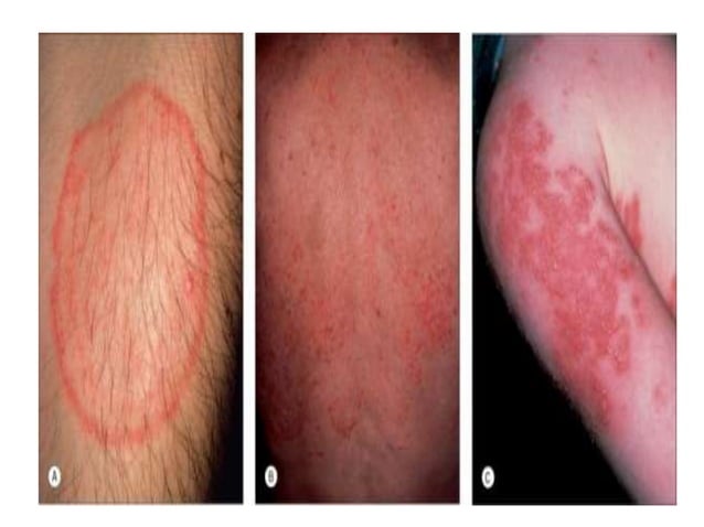 Dermatophyte infection (2).pptx | Skin and Dermatology | Diseases and ...