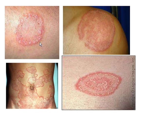 Dermatophyte infection (2).pptx | Skin and Dermatology | Diseases and ...