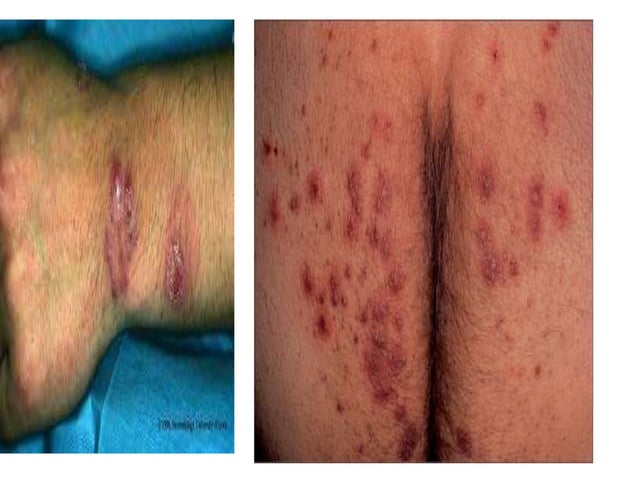 Dermatophyte infection (2).pptx | Skin and Dermatology | Diseases and ...