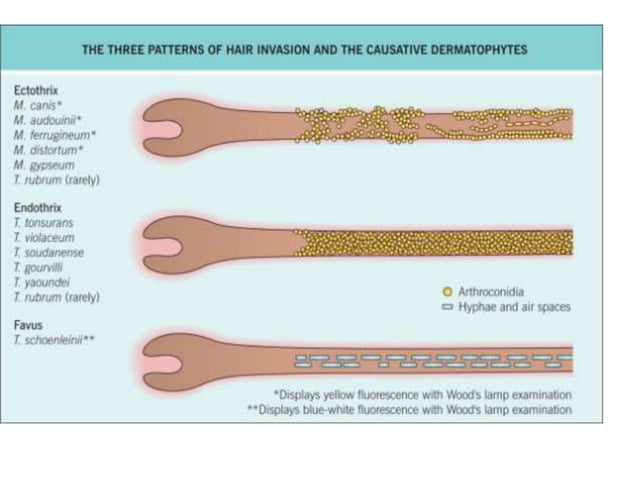 Dermatophyte infection (2).pptx | Skin and Dermatology | Diseases and ...