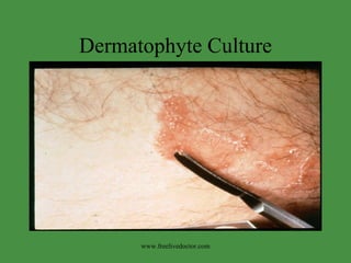Dermatophytes | PPT | Foot Health | Diseases and Conditions