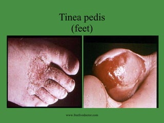Dermatophytes | PPT