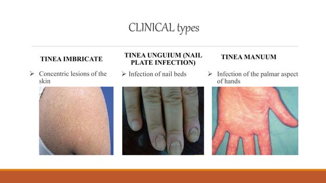Dermatophytes | PPTX | Skin and Dermatology | Diseases and Conditions