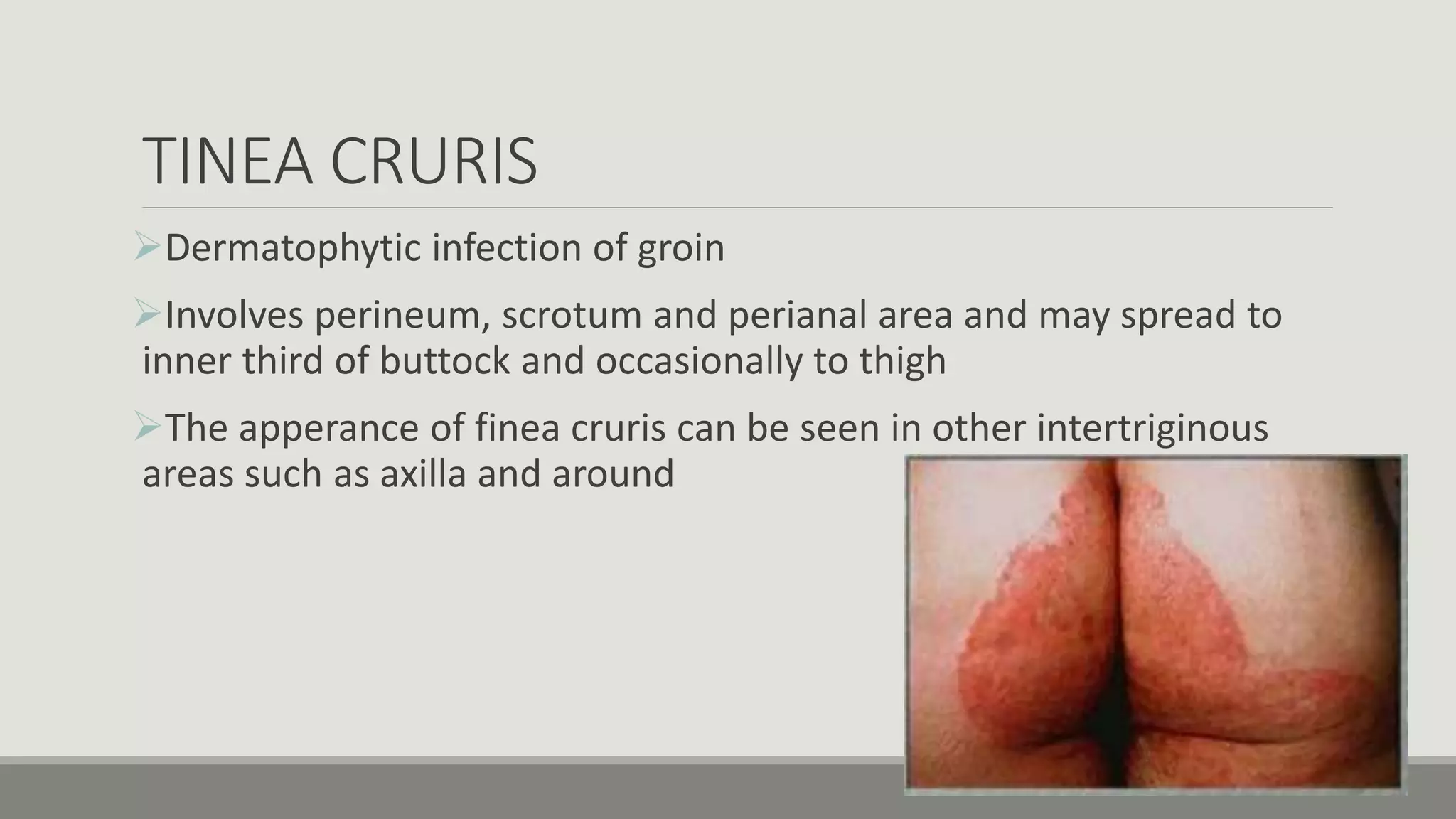 Dermato phytoses | PPTX