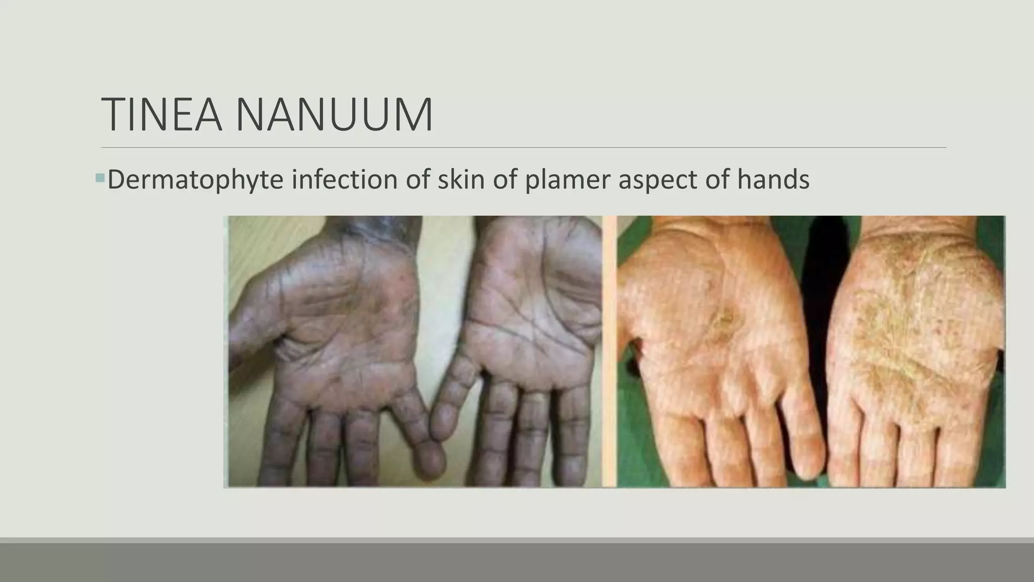 Dermato phytoses | PPTX