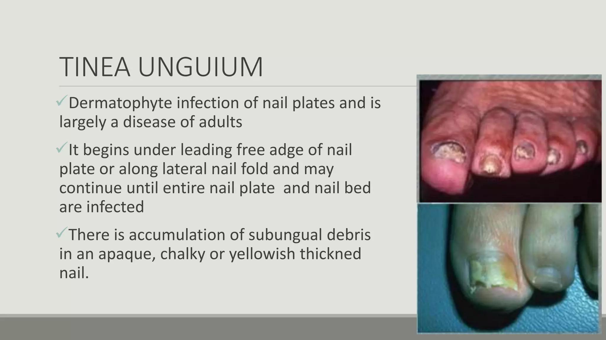 Dermato phytoses | PPTX