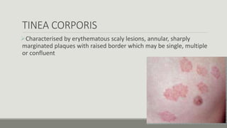 Dermato phytoses | PPTX