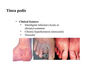 Dermatophytosis.2025.pptxsmsnsbxbssnnsssns | PPT