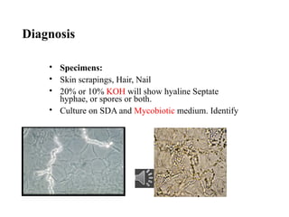 Dermatophytosis.2025.pptxsmsnsbxbssnnsssns | PPT