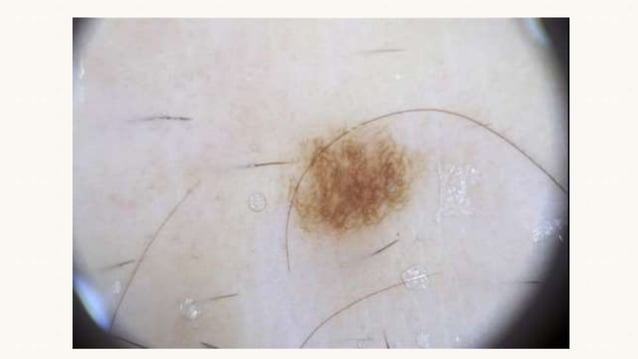 Dermatoscope and its application in dermatology | PPTX