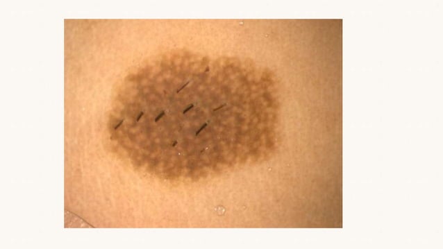 Dermatoscope and its application in dermatology | PPTX
