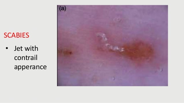 Dermatoscope and its application in dermatology