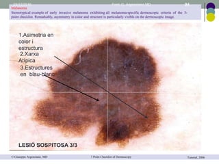 Dermatoscopia bàsica 260415 | PPTX
