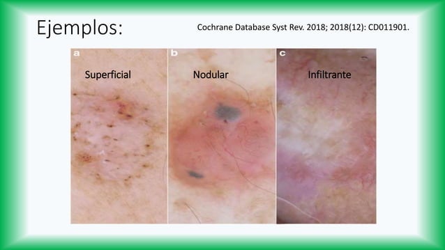 Dermatoscopía del Carcinoma Basocelular