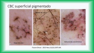 Dermatoscopía del Carcinoma Basocelular | PPT