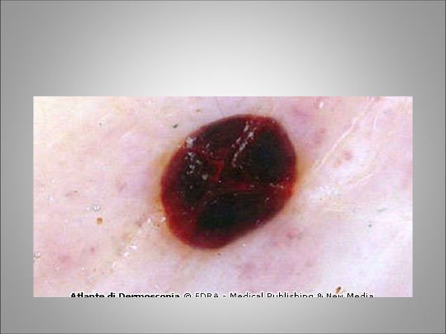 Dermatoscopia e Osservazione Epidermide | PPT | Skin and Dermatology ...