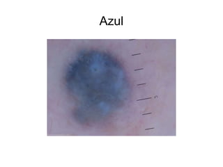 Dermatoscopia en Atención Primaria | PPT