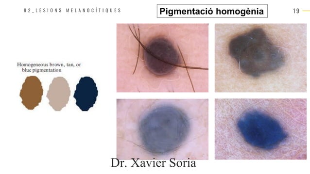 Dermatoscòpia. Aplicacions en Pediatria | PDF