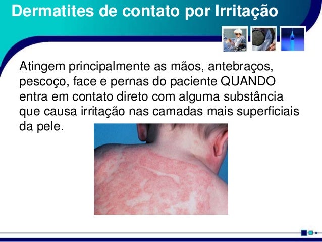 Dermatoses Ocupacionais