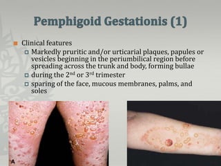 Dermatoses and pregnancy2 | PPT