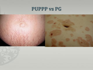 Dermatoses and pregnancy2 | PPT