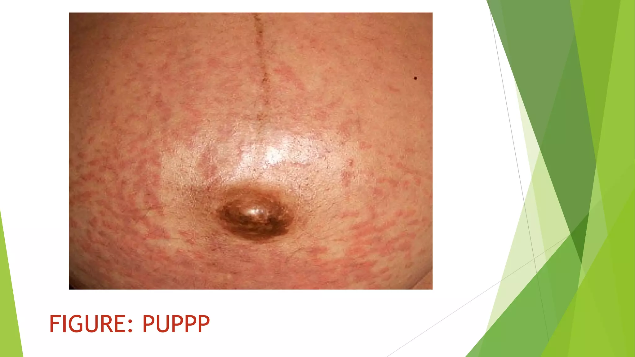 Dermatoses associated with pregnancy | PPT