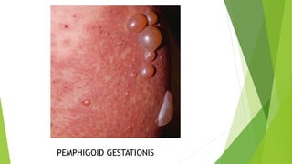 Dermatoses associated with pregnancy | PPT