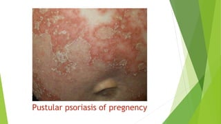 Dermatoses associated with pregnancy | PPT