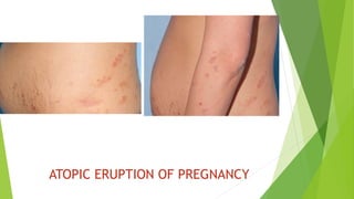 Dermatoses associated with pregnancy | PPT