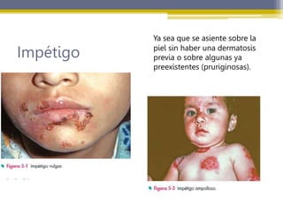 Dermatosis bacteriana | PPTX