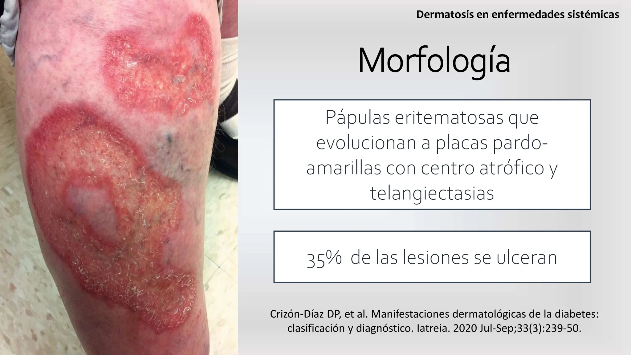 Dermatosis en Enfermedades Sistémicas (Diabetes Mellitus, Enfermedad ...