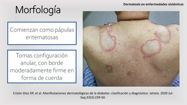 Dermatosis en Enfermedades Sistémicas (Diabetes Mellitus, Enfermedad ...