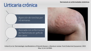 Dermatosis en Enfermedades Sistémicas (Diabetes Mellitus, Enfermedad ...
