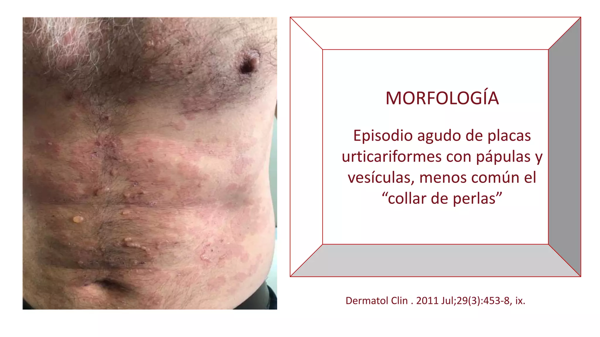 Dermatosis IgA Lineal (Enfermedad por IgA lineal) | PPTX