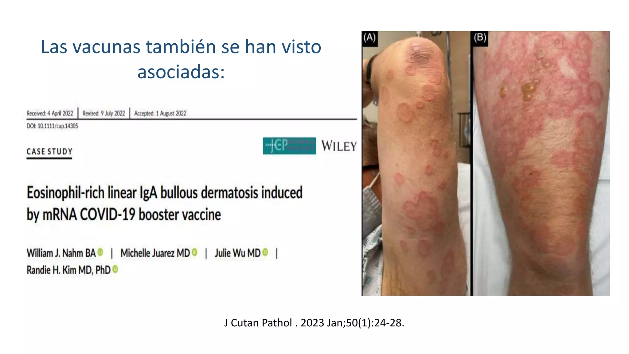 Dermatosis IgA Lineal (Enfermedad por IgA lineal) | PPTX