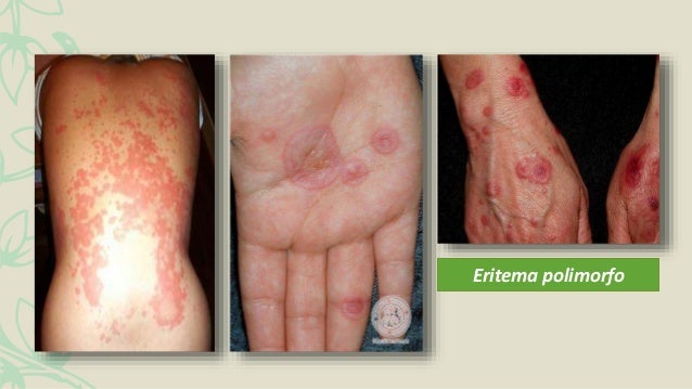 Dermatosis medicamentosa