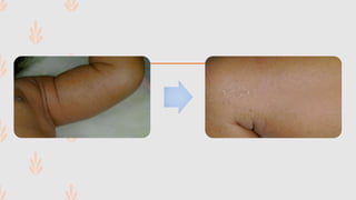 Dermatosis periodo neonatal por Dr. Carlos M. Montaño PEDIATRA EN LA ...