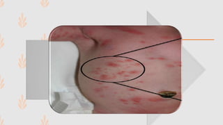 Dermatosis periodo neonatal por Dr. Carlos M. Montaño PEDIATRA EN LA ...
