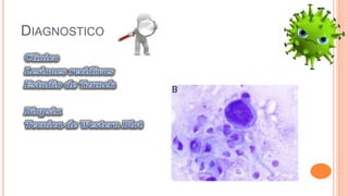 Dermatosis virales (herpes) | PPTX