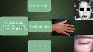 Dermatosis virales | PPTX