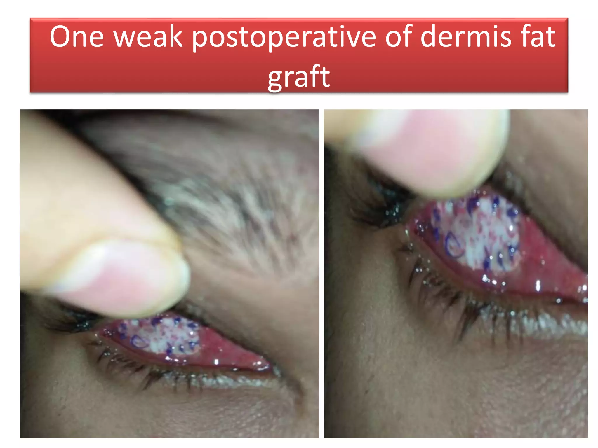 Dermis fat grafts | PPTX